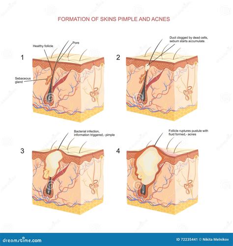 Pimple And Acnes Stock Vector Illustration Of Human