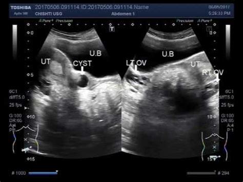 Cyst On Cervix Treatment