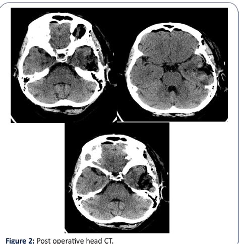 Figure 2 From Metastatic High Grade Intimal Sarcoma Of The Middle Cranial Fossa Case Report