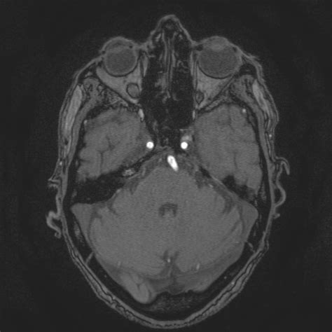 Neurovascular Compression Of Trigeminal Nerve Radiopaedia 67922 77361 Axial Mra Nc Commons