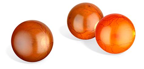 Retina Center Netra Klinik Mata