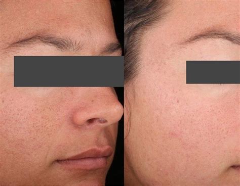Tca Peel Treatment Tca Chemical Peel Cutis Clinic