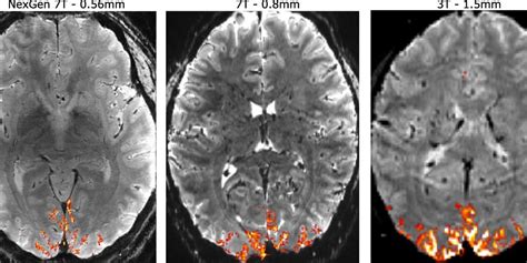 Next Gen Fmri Improves Spatial Resolution 10 Fold Ieee Spectrum