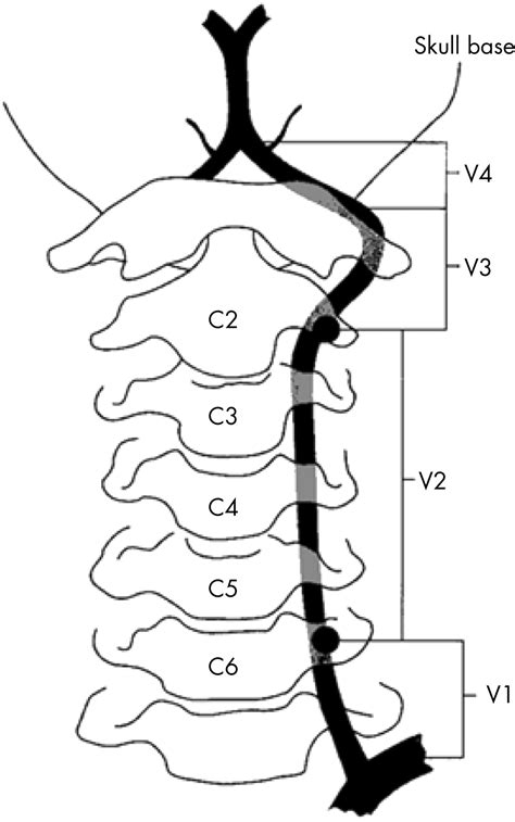 Imaging Of Vertebral Artery Stenosis A Systematic Review Journal Of Neurology Neurosurgery