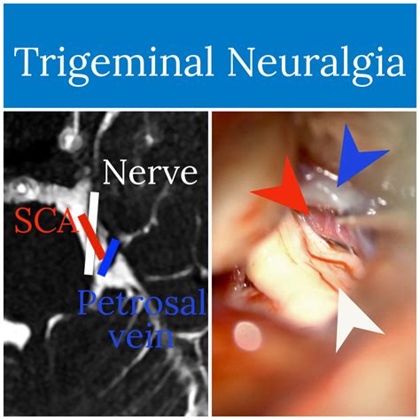 Trigeminal Neuralgia