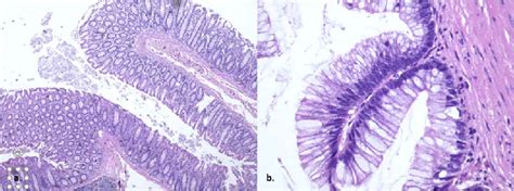 The Histopathology Showed A Low Grade Appendiceal Mucinous Neoplasm Download Scientific Diagram