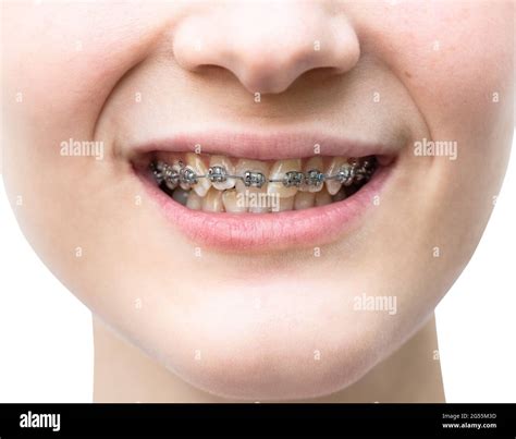 Front View Of Metal Dental Braces On Teeth Of Upper Jaw Of Girl Closeup Cutout On White