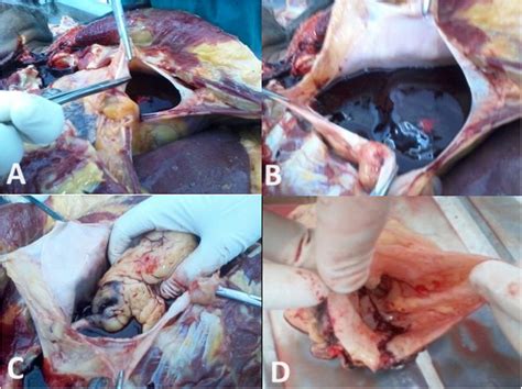 Ruptured Dissecting Aorta An Uncommon Cause Of Sudden Death—an Autopsy