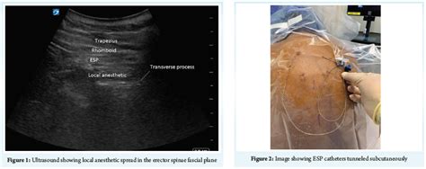 Perioperative Analgesia For Forequarter Amputation In A Morbidly Obese