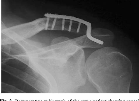 Arthroscopic Assisted Hook Plate Fixation For Acromio