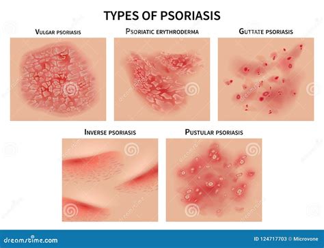 Medical Description Of Skin Rashes At Layla Swallow Blog