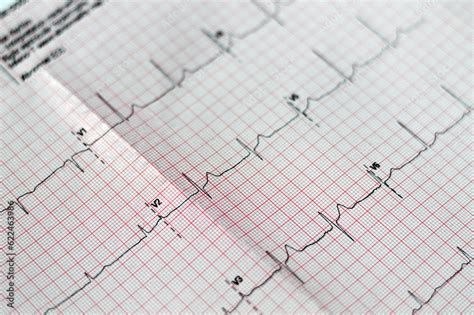 Photo And Art Print Ecg Electrocardiograph Paper That Shows Sinus Rhythm