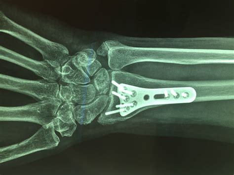 3 Years Post Orif Distal Radius Asymptomatic Forum 2016 G Clembosky