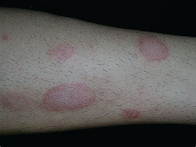 Dry Spots On Lower Legs Mdedge