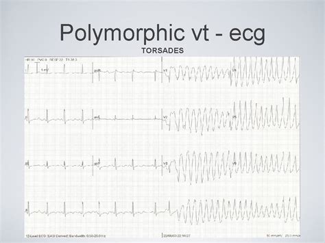 Recognizing Cardiac Arrhythmias Normal Anatomy Normal Ecg Normal