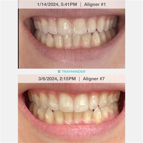 Open Bite Progress Rinvisalign