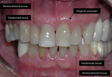 Gingival Grafting Wikipedia