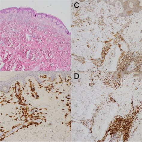 Biopsy Specimen Of A Cutaneous Rash On The Abdomen Showing