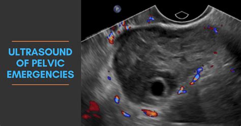 Ultrasound Evaluation Of Pelvic Emergencies A Comprehensive Overview