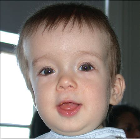 Congenital Craniofacial Deformities Clinician Reviews