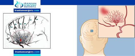 What Is The Cause Of Moyamoya Disease Moyamoya Disease Diagnosis