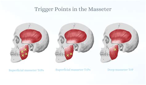 Masseter Muscle Pain Treatment Aca Acupuncture And Wellness