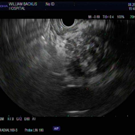 Hypoechoic Gland With Hyperechoic Foci Without Shadowing Download Scientific Diagram