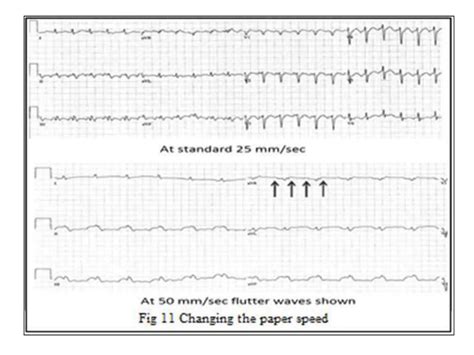 Artifacts In Ecgpptx Heart And Cardiovascular Diseases Diseases