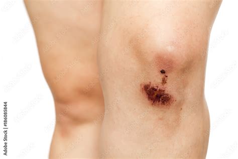 Foto De Wound With Scabs On The Knee Of A Woman Do Stock Adobe Stock