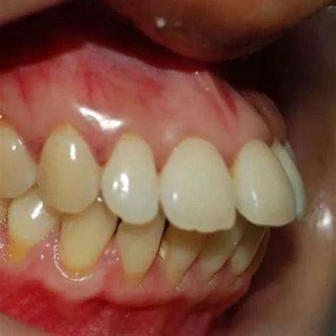 孩子有3次改变牙齿不齐的“黄金期”，爸妈千万别错过！ 吐舌头 牙周 口腔