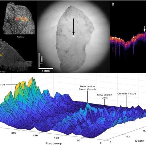 Three Dimensional Color Coded Oct Images A Of A Superficial Basal