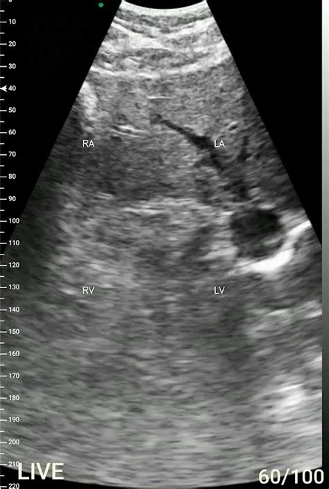 Subxiphoid Echo Youtube