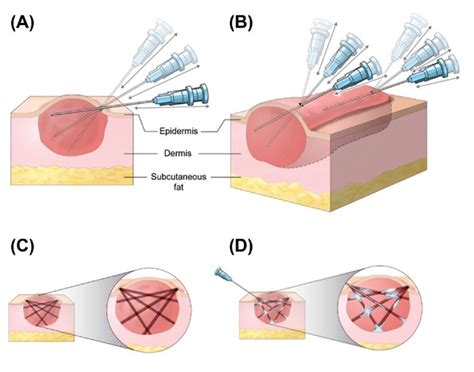 켈로이드 치료에 효과적인 주사 방법 있다