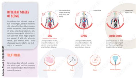 Infographics Evolution Of Sepsis Stages And Possible Treatments Stock Vector Adobe Stock