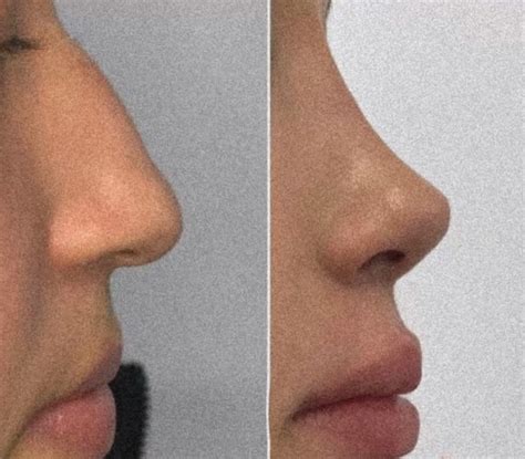 Pixie Nose Rhinoplasty Nose Jobs Nose Surgery Nose Job