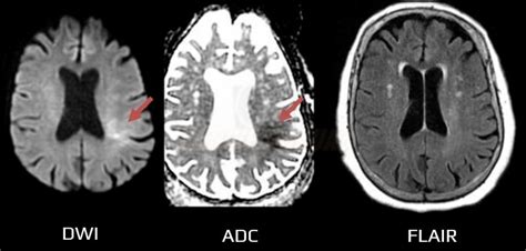 Wake Up Stroke STROKE MANUAL