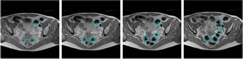 Example Of Manual Sigmoid Segmentation In T2‐weighted T2w Mri Shown