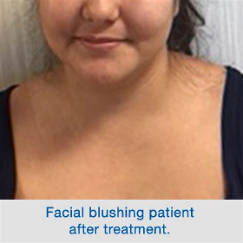 Ets Surgery For Facial Blushing Nyc The Center For Hyperhidrosis