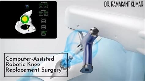 Computer Assisted Robotic Knee Replacement Surgery Dr Ramakant