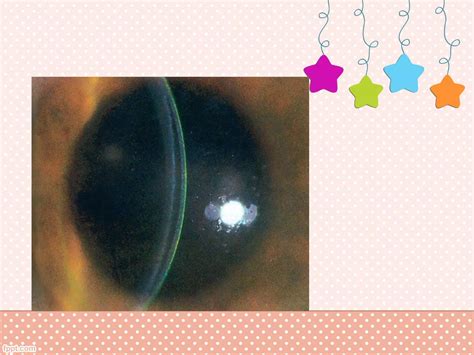 Diffuse Lamellar Keratitis Dlk Ppt