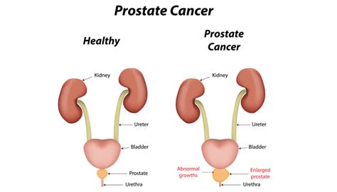 Early Stages Of Prostate Cancer And Treatment And Risk Factors