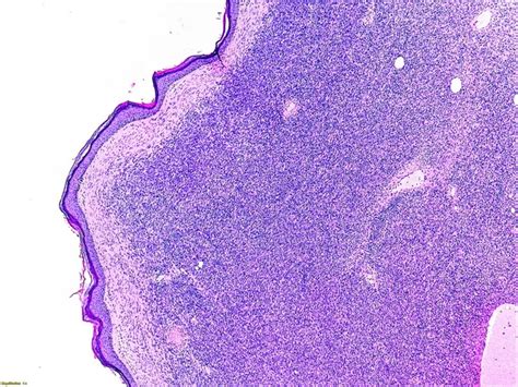 Dermatofibrosarcoma Protuberans