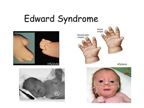 Ppt Karyotype Powerpoint Presentation Free Download Id2171200
