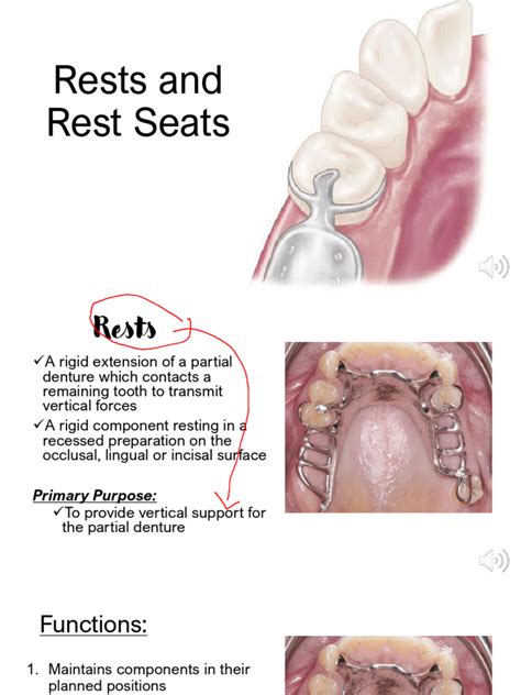 Rpd Rests And Rest Seats Pdf Dentistry Branches