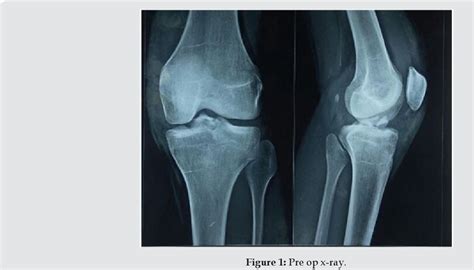 Figure 1 From Arthroscopic Fixation Of Tibial Spine Avulsion Fractures Strangulation Technique