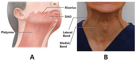 Botulinum Neurotoxin Injection Targeting The Platysma Muscle