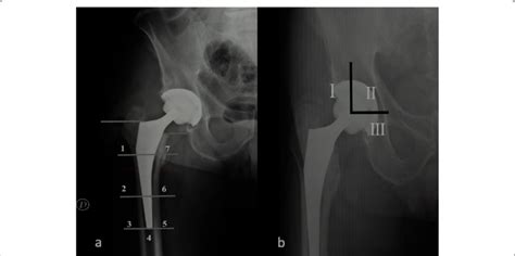 Areas Of Osteolysis 7 Areas Of Femoral Osteolysis According To Gruen Download Scientific