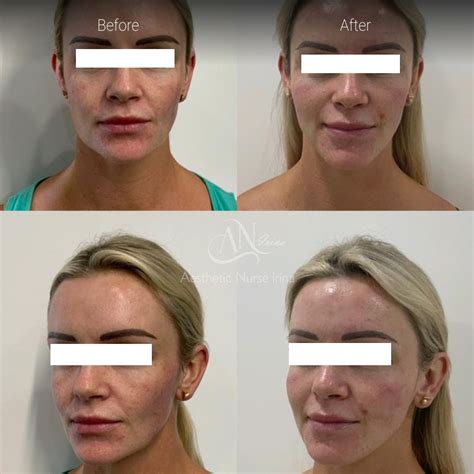 Collagen Stimulation Gold Coast Aesthetic Nurse Irina