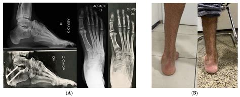 Cavus Foot Correction Using A Full Percutaneous Procedure A Case Series