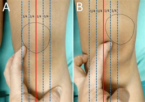 Patellar Dislocation Workup And Decision Making Pmc